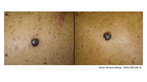 Nodular Melanoma Causes Symptoms And Treatments