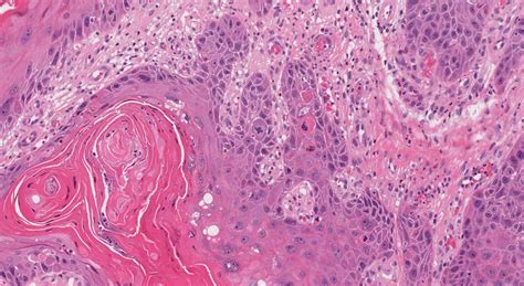 Hpv Independent Squamous Cell Carcinoma Of The Penis Ottawa Atlas Of