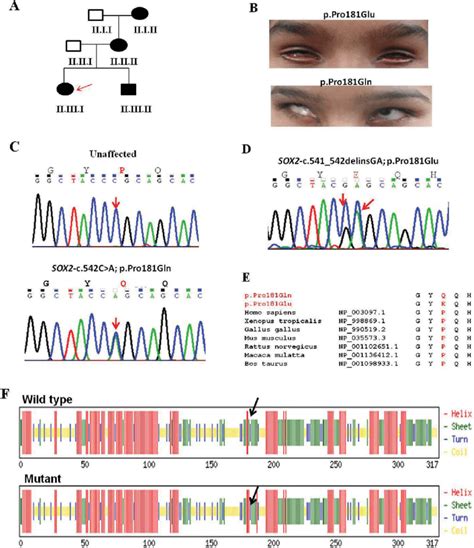 Sox2 Gene Mutation In Patients With Isolated Microphthalmia And