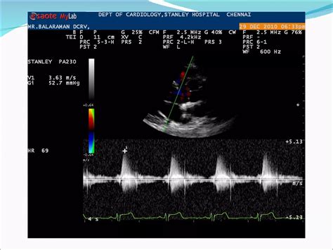 Echocardiogram With Basics Ppt