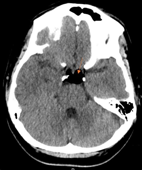 Computed Tomography Head Showing Air Within The Suprasellar Cistern