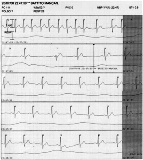 Atrial Fibrillation Associated With Exogenous Subclinical Hyperthyroidism International