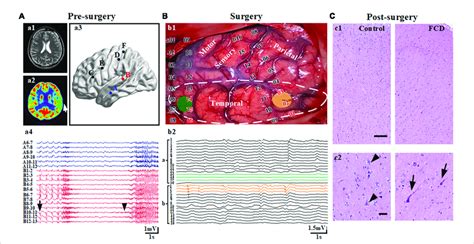 Localization Of The Seizure Onset Zone Soz And Non Seizure Onset Zone Download Scientific