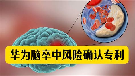华为脑卒中风险确认专利公布，科技界托拉斯、or行业“百草枯”？ Youtube