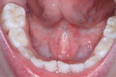 Lip And Tongue Tie Procedure Results Brentwood Tn Dentist