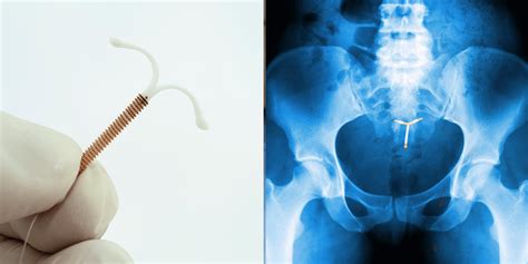 Proper Location For Iud On X Ray Stock Image X Ray Of The Pelvis