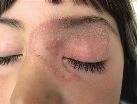 Eyelid Fungal Infection