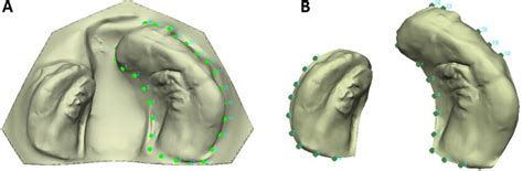 Dental Arch With Unilateral Cleft Lip And Palate A Palatal Bone