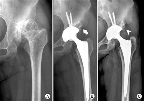 Preoperative Radiograph Showing Crowe Type Iii Developmental Dysplasia Download Scientific