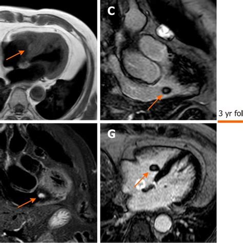 Seventy One Year Old Female With Incidental Finding Of Cardiac Mass