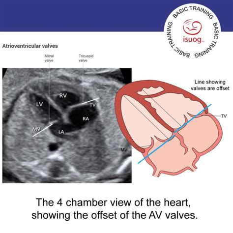 Isuog International Society Of Ultrasound In Obstetrics And Gynecology On Linkedin 4 Chamber