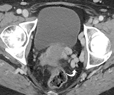 Imaging Appearance And Nonsurgical Management Of Pelvic Venous