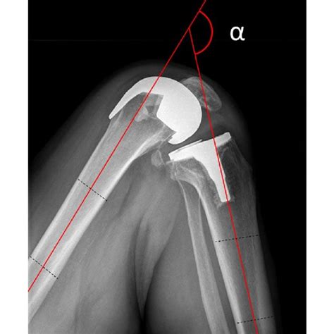 Maximal Flexion Measured On A Lateral Radiograph The Dashed Black