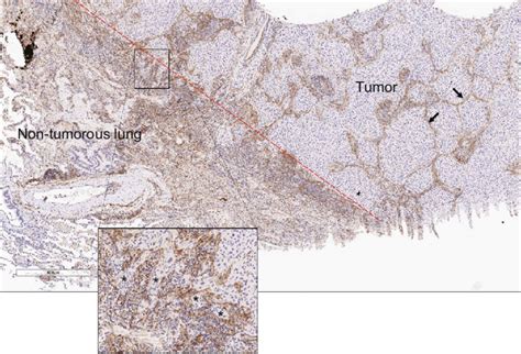 Thy 1 Expressing Cells Localize Within The Tumor Interstitium And On Download Scientific