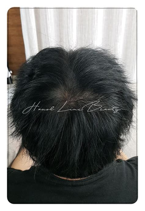 부평두피문신 남성20대 Smp밀도보강 시술후기
