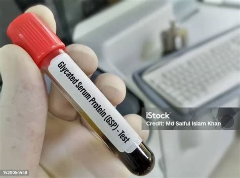 당화 혈청 단백질 검사 당뇨병 검사 개념을위한 혈액 샘플 개념에 대한 스톡 사진 및 기타 이미지 개념 개념과 주제 건강
