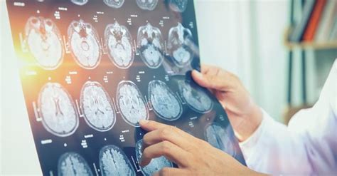 Câte Microparticule De Plastic Ai în Creier