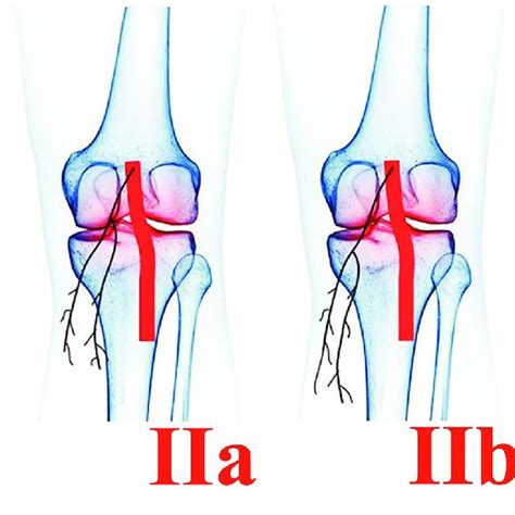 This Medial Sural Artery Perforator Msap Flap Thickness As Measured