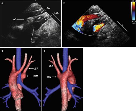 Vascular Ring Double Aortic Arch Totallybery