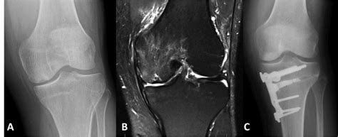 A Anteroposterior X Ray View Of A Medial Femoral Condyle