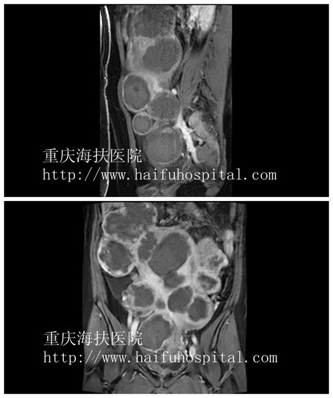 未婚白领如同怀孕8月 都是子宫肌瘤惹的祸重庆海扶医院