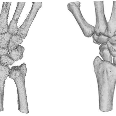 comparison of segmented raw data of the wrist from msct left and cbct