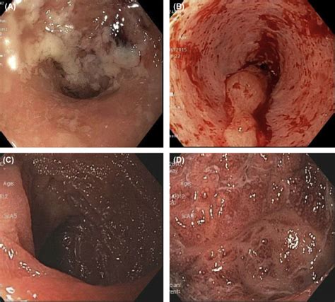 Treatment And Management Of Diversion Colitis Brown Taylor