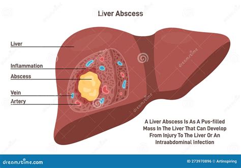 Liver Abscess Human Internal Organ Tissue Inflammation And Pus