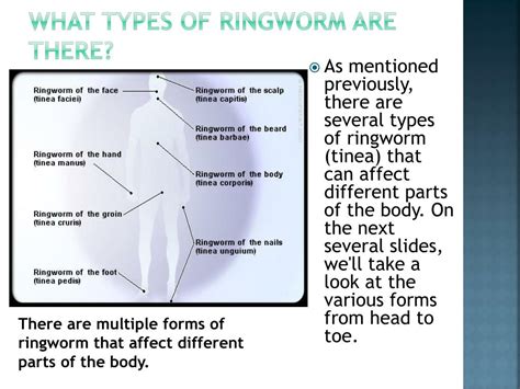 PPT Ringworm PowerPoint Presentation Free Download ID 2634085