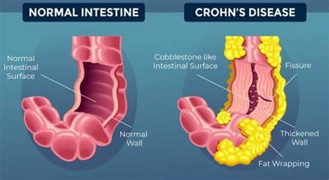 Crohns Disease