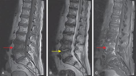 Discitis Osteomyelitis Neupsy Key