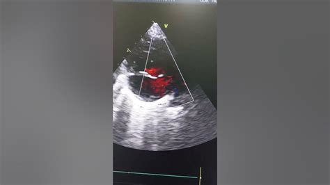 Complete Av Canal Defect Rastelli Type A Youtube