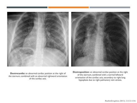 segmental approach to congenital heart disease pdf heart and