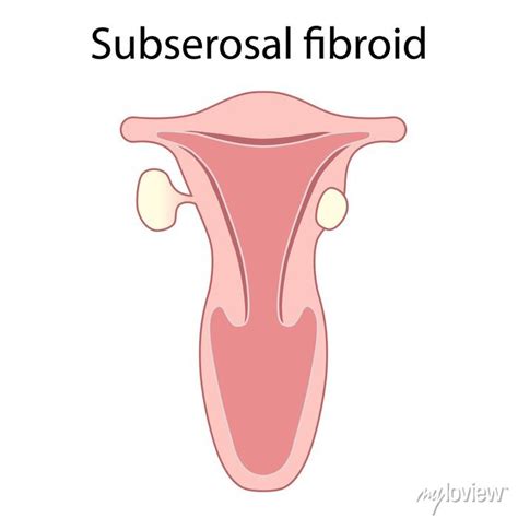 Subserosal Fibroid Female Reproductive Organ Pathology Benign Posters For The Wall • Posters