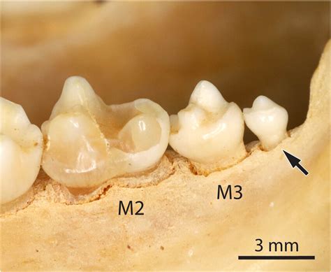 Supernumerary Tooth Associated With The Third Mandibular Molar Tooth