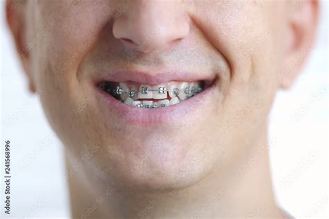 Braces On Ugly Teeth At Beth Anker Blog Braces On Ugly Teeth At Beth Anker Blog