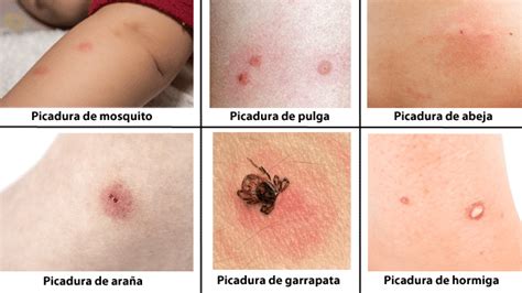 Cómo Saber Si Me Pico Una Araña Mibbmemima ️