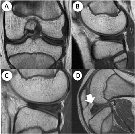 Normal Mri Knee