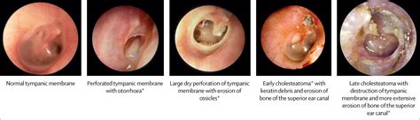 Acute Serous Otitis Media