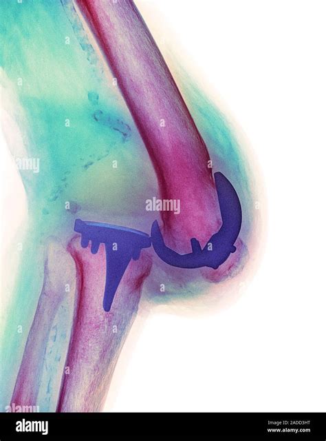 Dislocated Knee X Ray Of The Dislocated Knee Of A 92 Year Old Woman