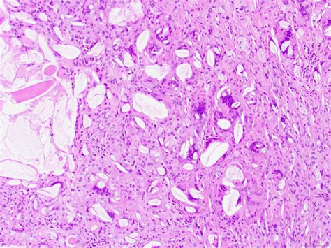 Pathology Outlines Epidermoid Epidermal Inclusion Cyst