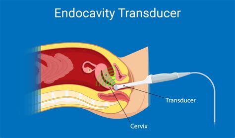 What Is An Endocavitary Transducer Elzhen Blog