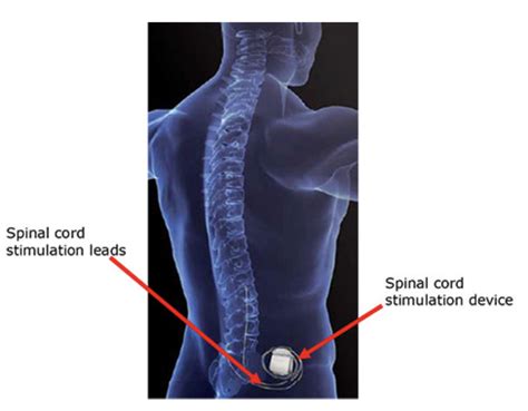 Spinal Cord Stimulation Overview How Its Done Benefits