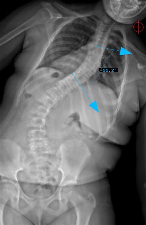 Lenke Class 1cn Harms Study Group