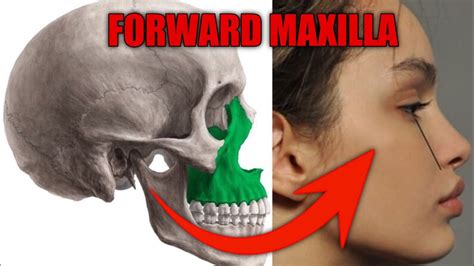 I Fixed My Recessed Maxilla Without Surgery Viral Method Youtube