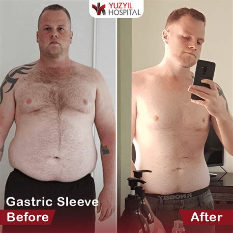 Gastric Bypass