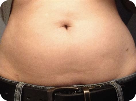 After My Tubal Ligation Recovery Insurance Erocentric