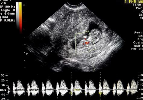 Ultrassom Abdominal Detecta Gravidez De Quantas Semanas Maternidade