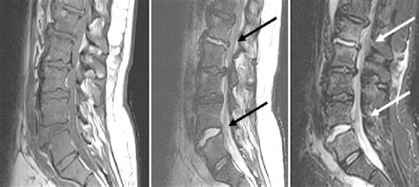 Pyogenic Spondylodiscitis — Sagittal T1t2 And Stir Images Areas Of