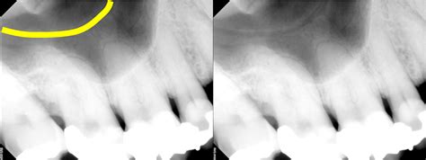Anatomy Monday Canals On Intraoral Radiographs Dr Gs Toothpix